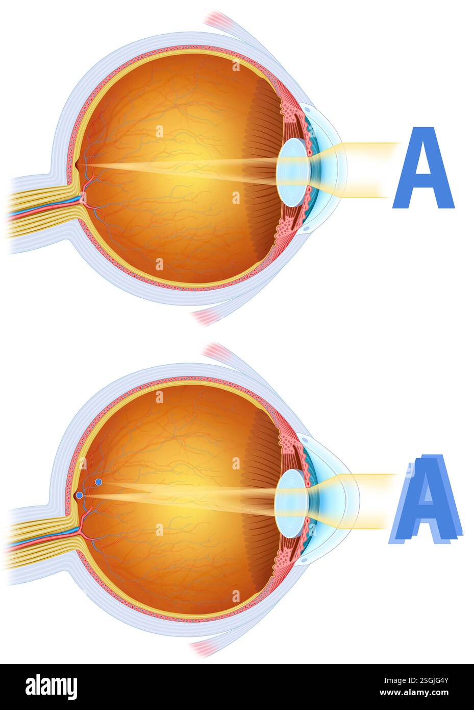 Illustration composed of two images of the eye, Normal and with ...