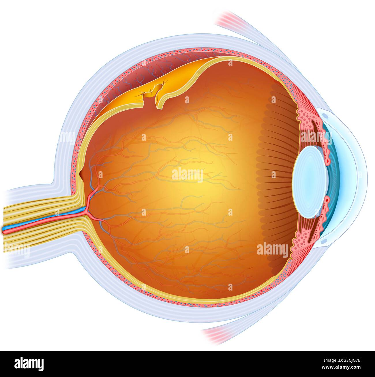 Representation of retinal detachment. Eye emergency where the retina ...