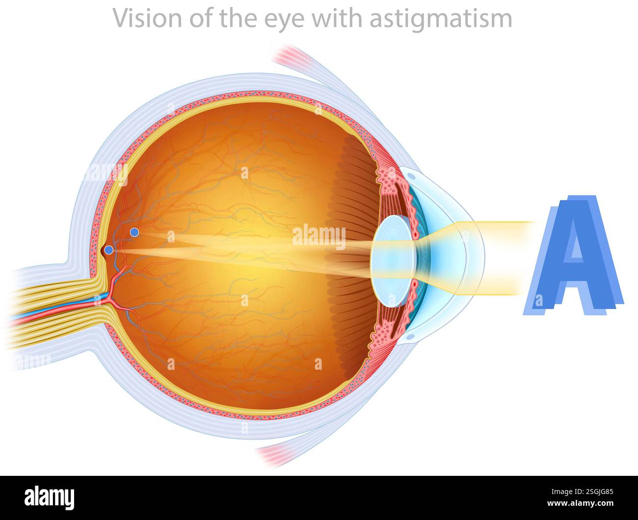 Illustration of the vision of the eye with astigmatism, blurred or ...