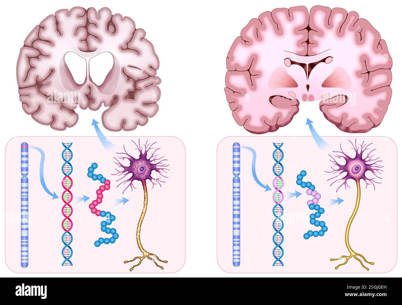 Diagram of Huntington's disease. Hereditary neurodegenerative disorder ...