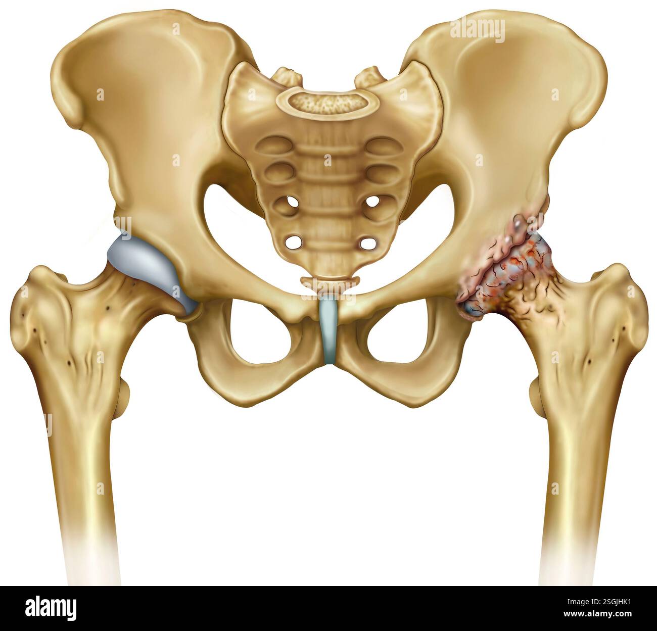 Diagram of osteoarthritis, a degenerative disease that affects the ...