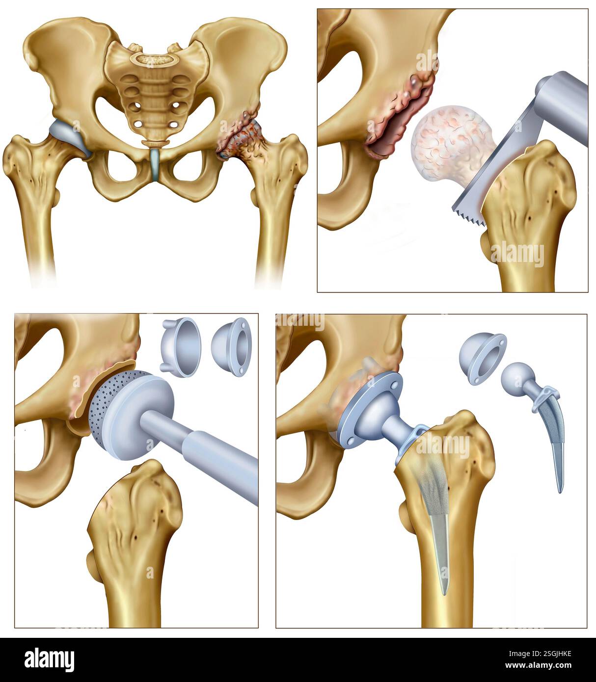 Illustration on the treatment of hip osteoarthritis. Degenerative ...