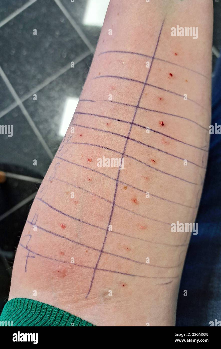 Allergietest 31.01.2025, Weimar, Allergietest, Linien wurden auf den ...