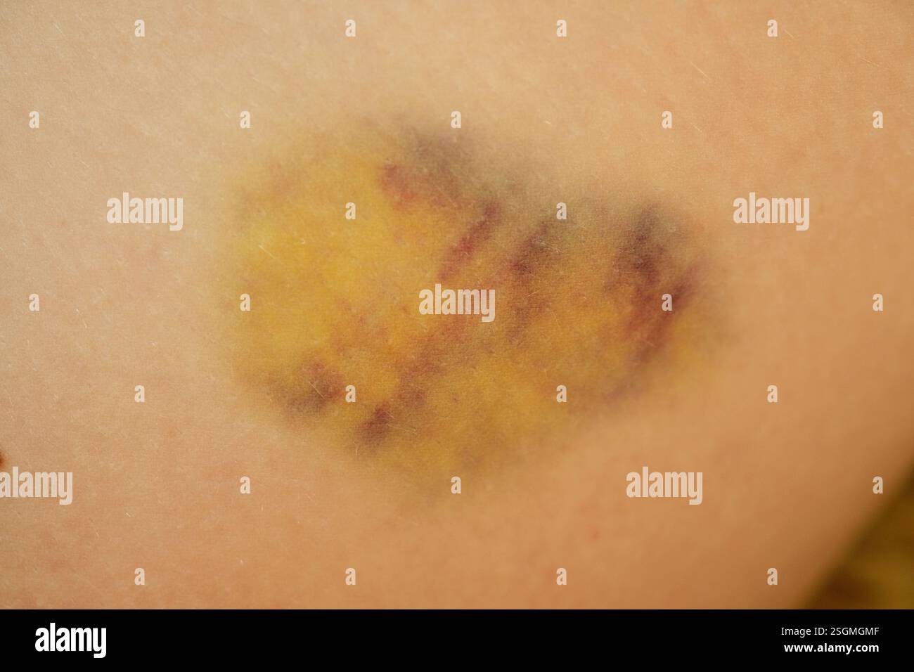 A closeup image showing a bruise on the skin caused by a dog bite ...