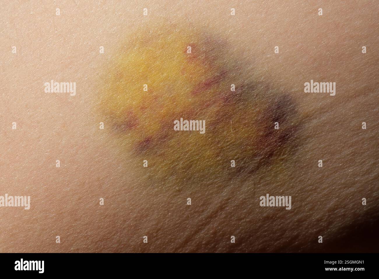 Dog bite wound hi-res stock photography and images - Alamy