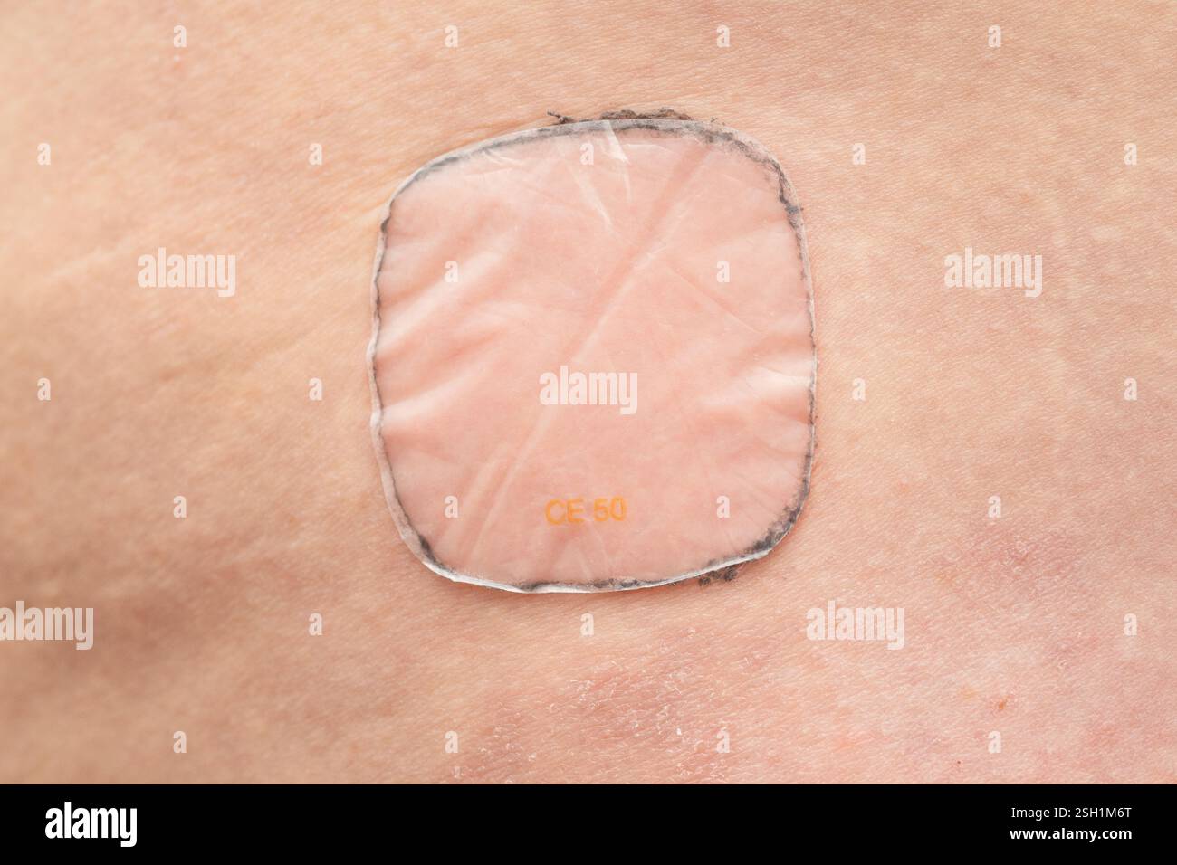 Hormone Replacement Therapy medication: removing an Evorel 50 ...