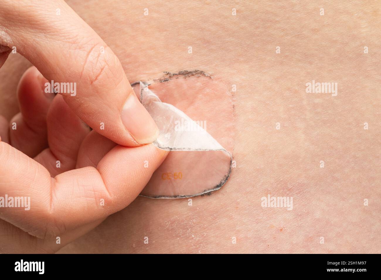 Hormone Replacement Therapy medication: removing an Evorel 50 ...