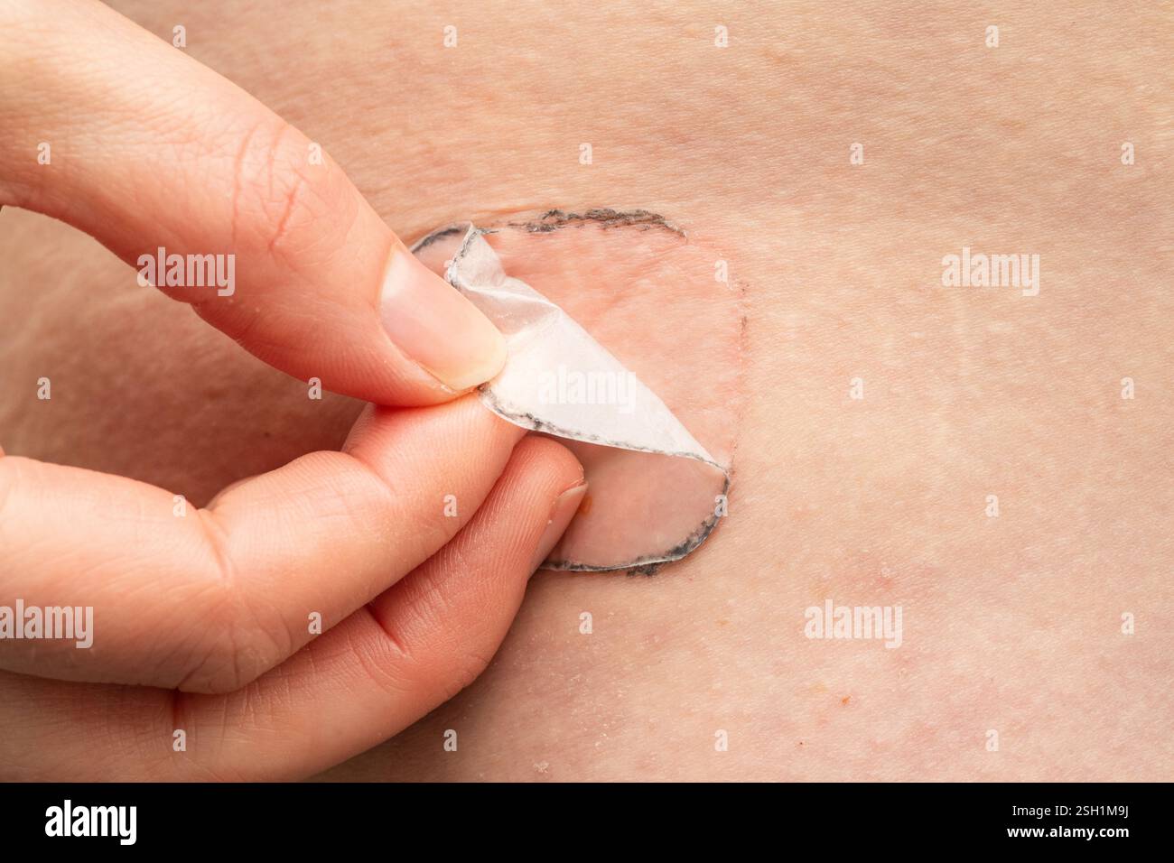 Hormone Replacement Therapy medication: removing an Evorel 50 ...