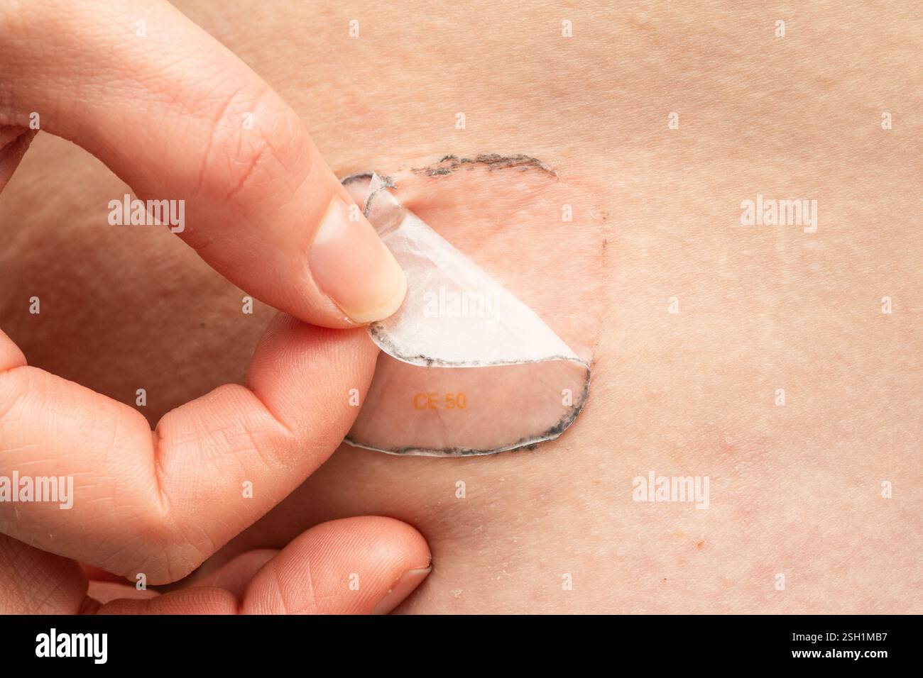 Hormone Replacement Therapy medication: removing an Evorel 50 ...