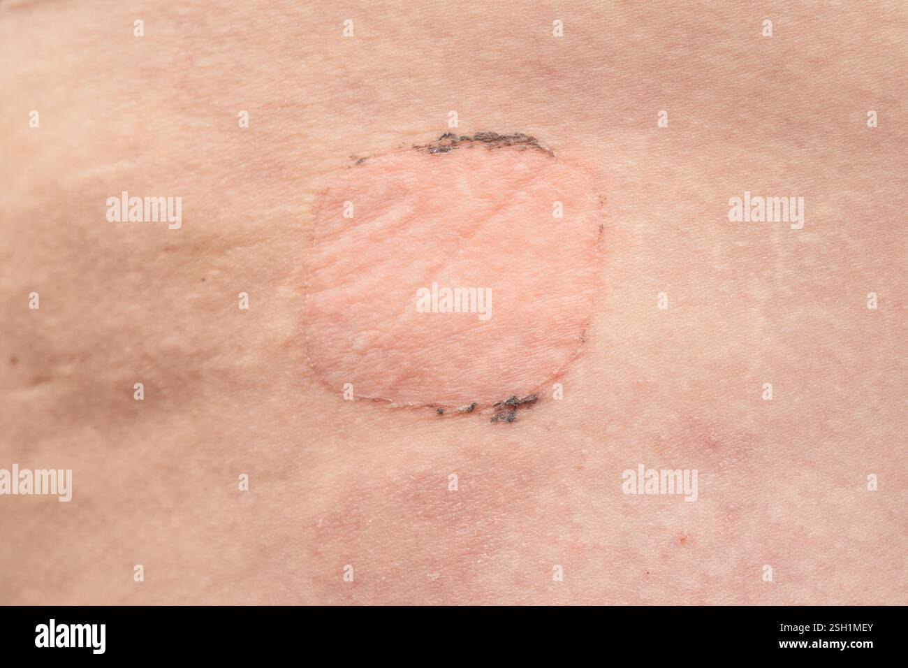 Hormone Replacement Therapy medication: removing an Evorel 50 ...