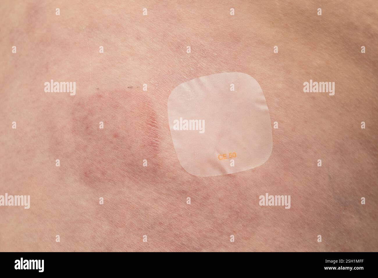 Hormone Replacement Therapy medication: removing an Evorel 50 ...