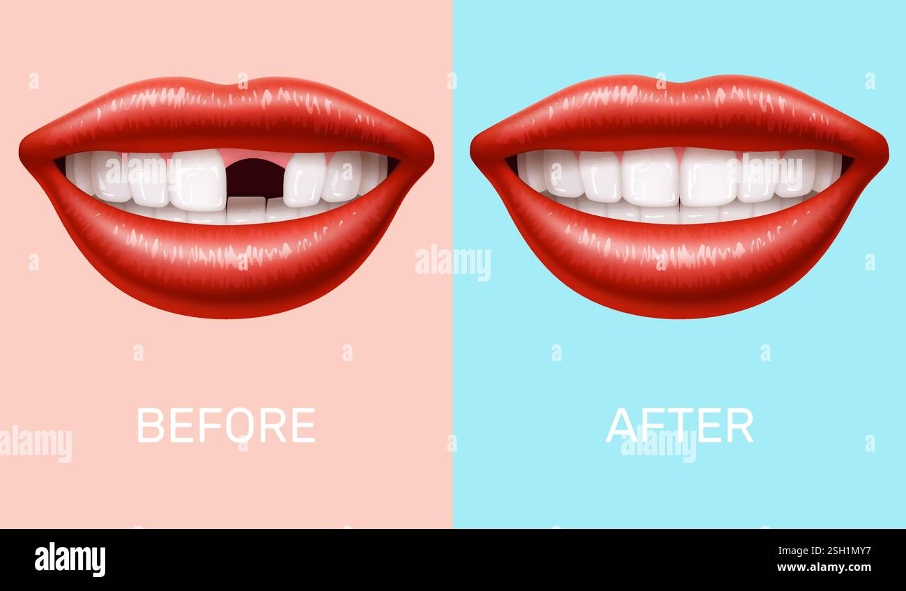 Woman mouth without tooth. Teeth implantation. Realistic woman mouth ...