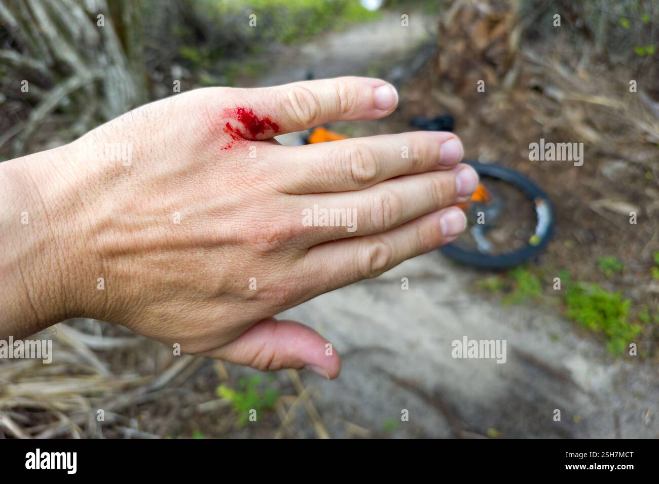 Arm injury while riding mountain bike on Florida jungle trails. Red ...