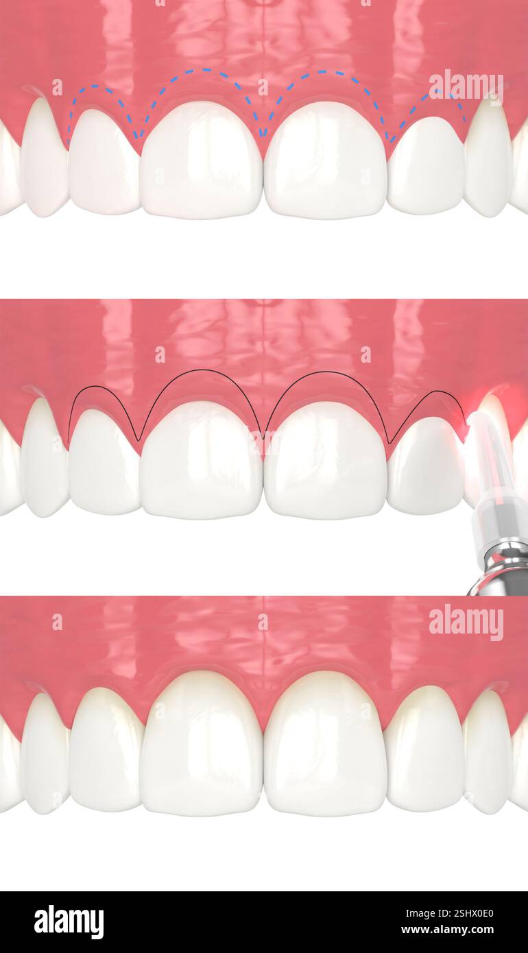 3D rendering of the step-by-step procedure of laser treatment for gummy ...