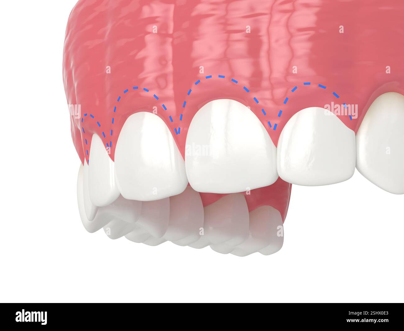3d render of upper jaw with gummy smile and corrected gum line Stock ...