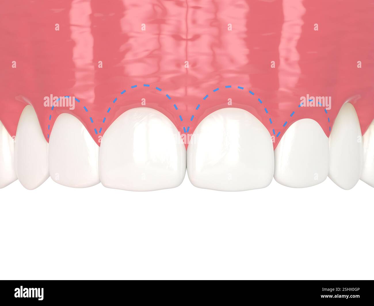 3d render of upper jaw with gummy smile and corrected gum line Stock ...