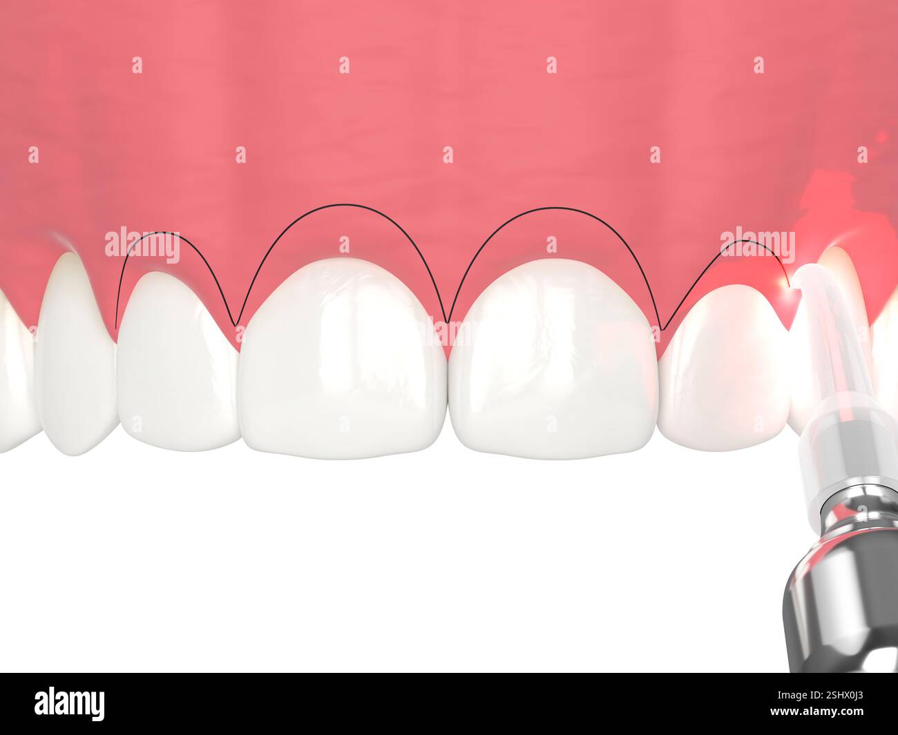 3d render of upper jaw treated with laser for gummy smile. Creating a ...