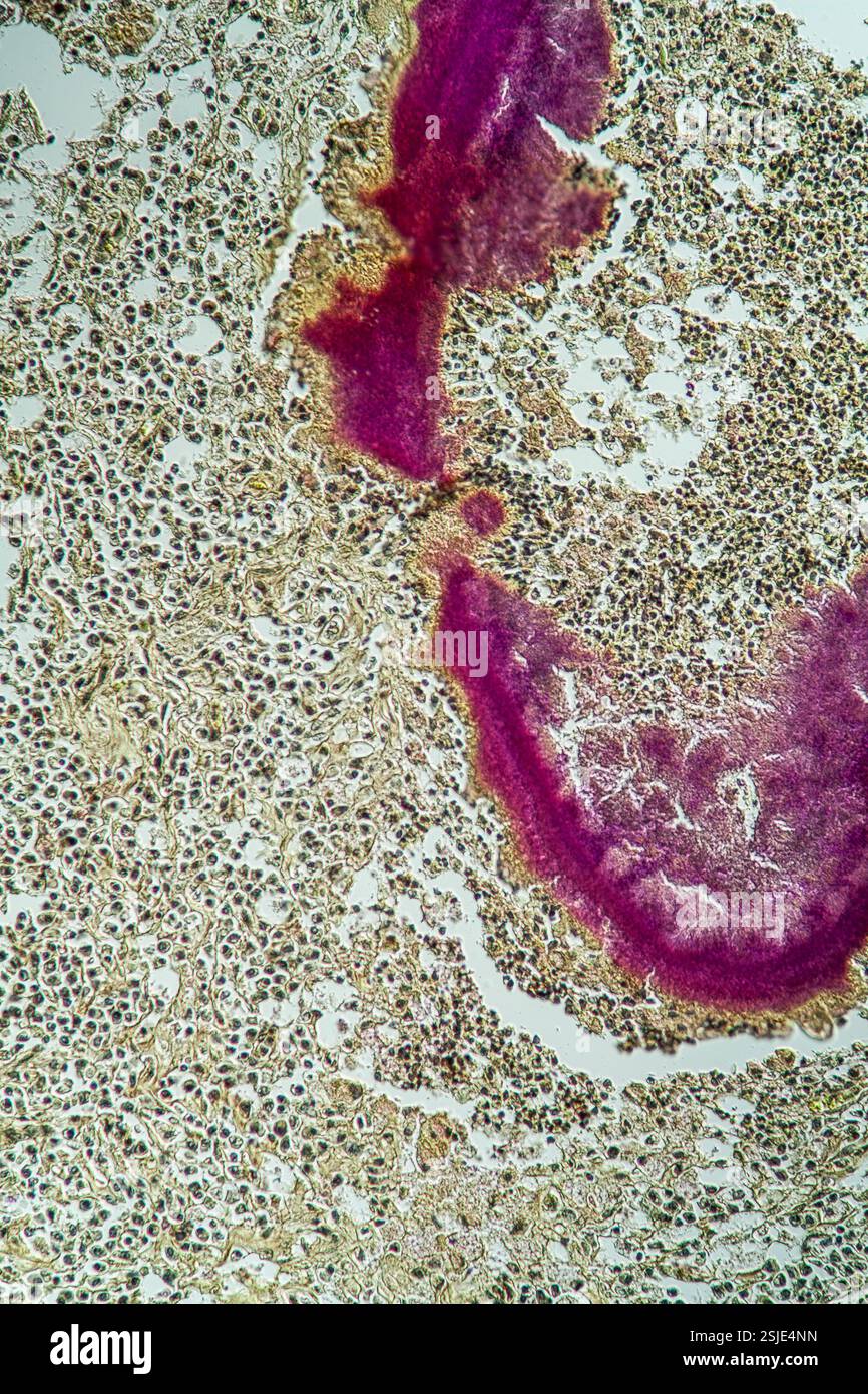 Bacterial disease under the microscope 200x Stock Photo - Alamy