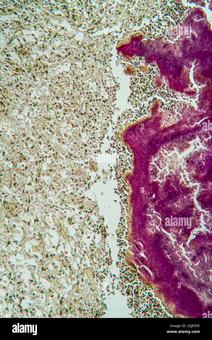 Bacterial disease under the microscope 100x Stock Photo - Alamy