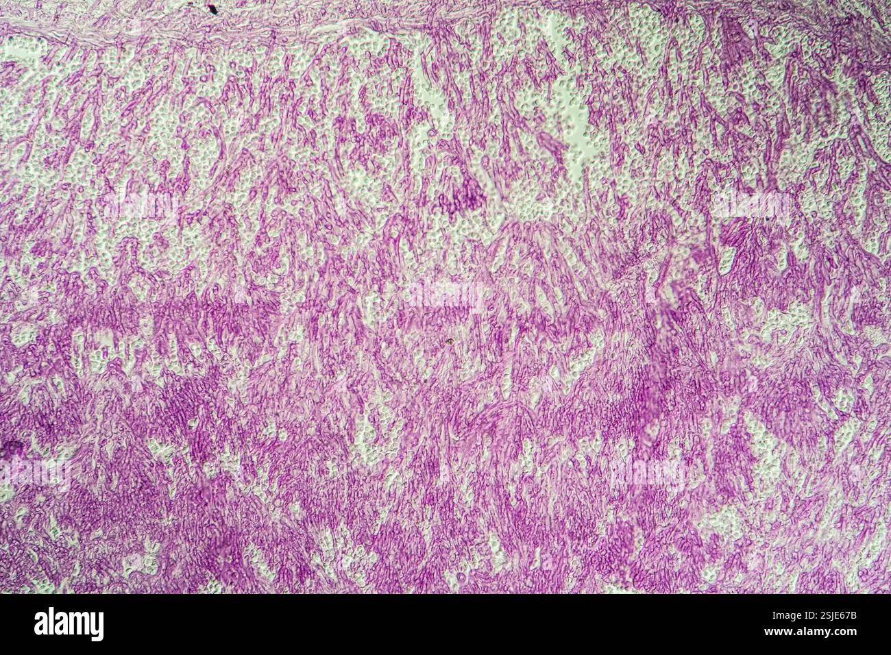 Infection with Candida and Aspergillus after AIDS 100x Stock Photo - Alamy