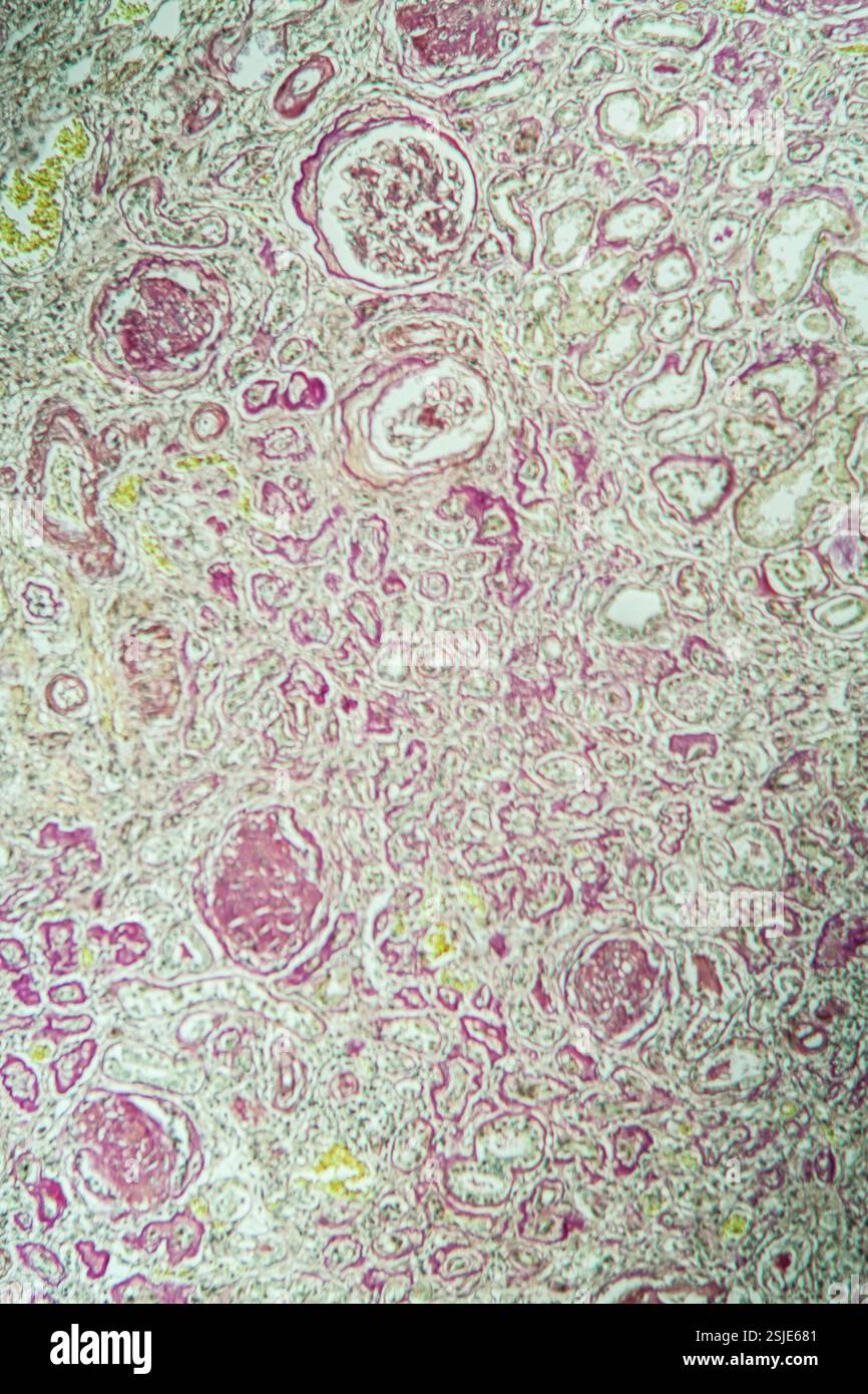 Kidney diseased tissue under the microscope 100x Stock Photo - Alamy
