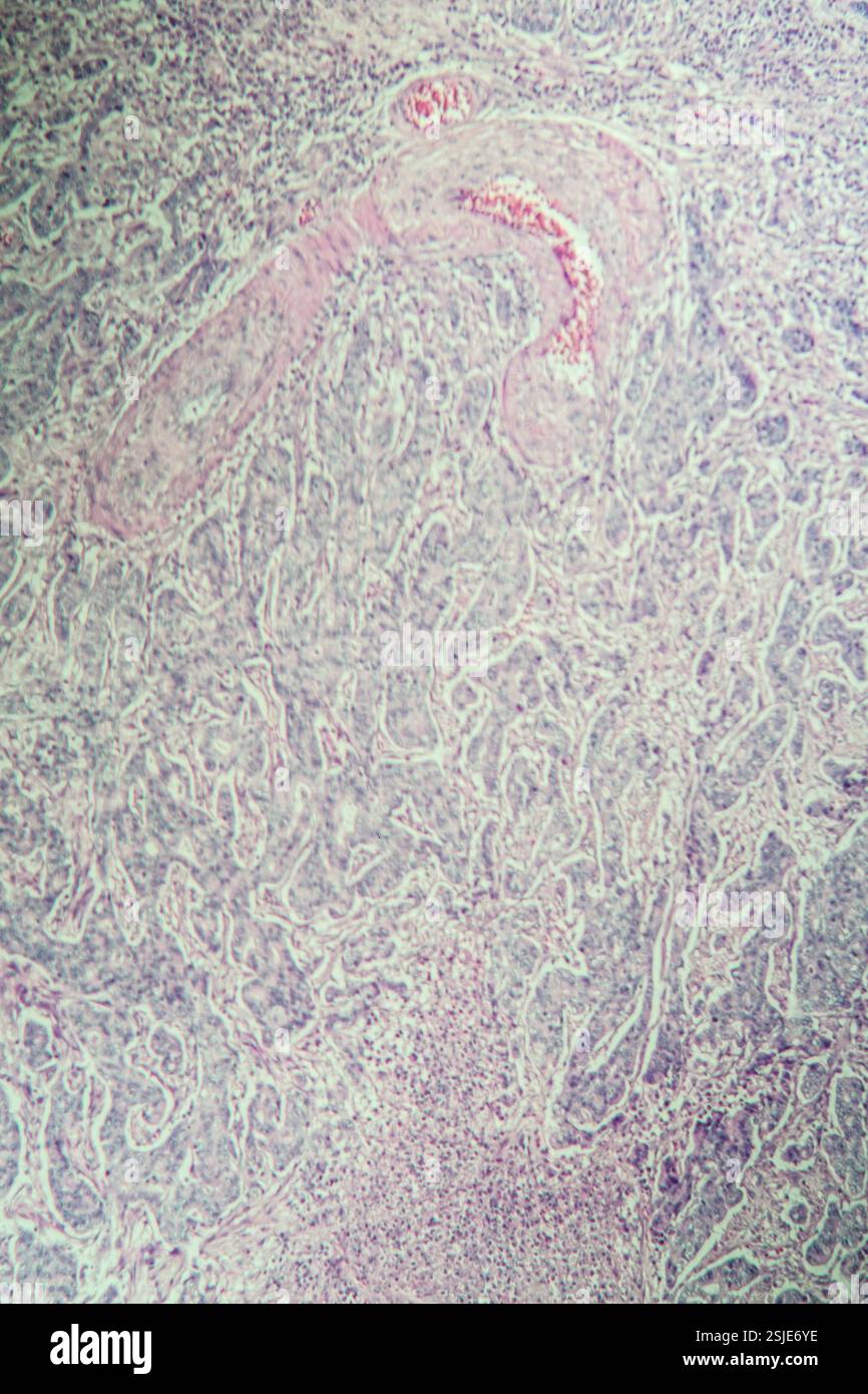 Stomach cancer tissue under the microscope 100x Stock Photo - Alamy