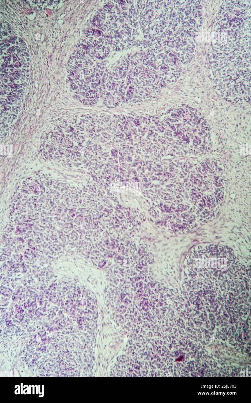 Tumor diseased tissue under the microscope 100x Stock Photo - Alamy