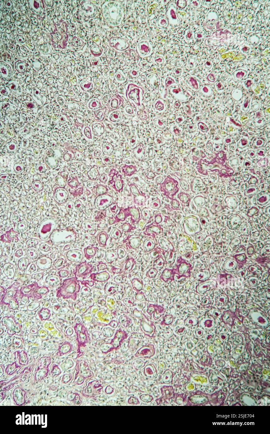 Kidney diseased tissue under the microscope 100x Stock Photo - Alamy