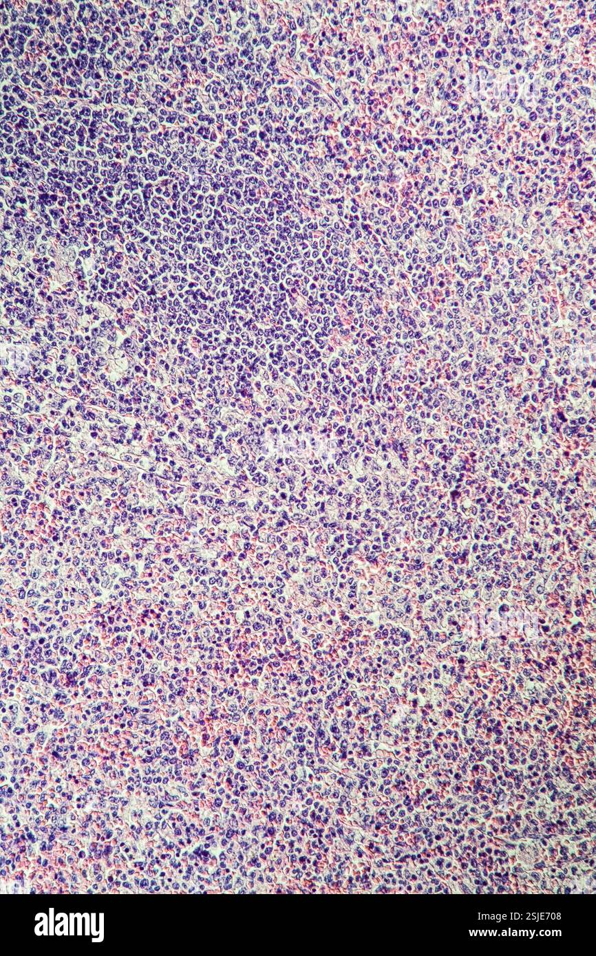 Liver diseased tissue under the microscope 100x Stock Photo - Alamy