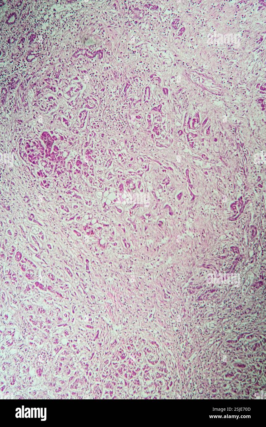 Liver diseased tissue under the microscope 100x Stock Photo - Alamy
