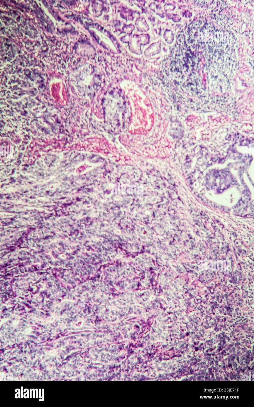 Carcinoma Tissue section under the microscope 100x Stock Photo - Alamy
