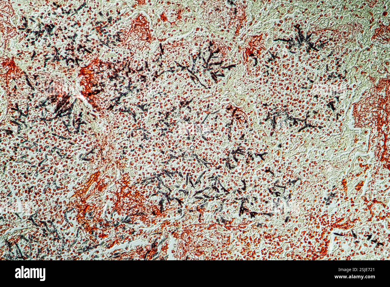 AIDS lung tissue with infection under the microscope 200x Stock Photo ...