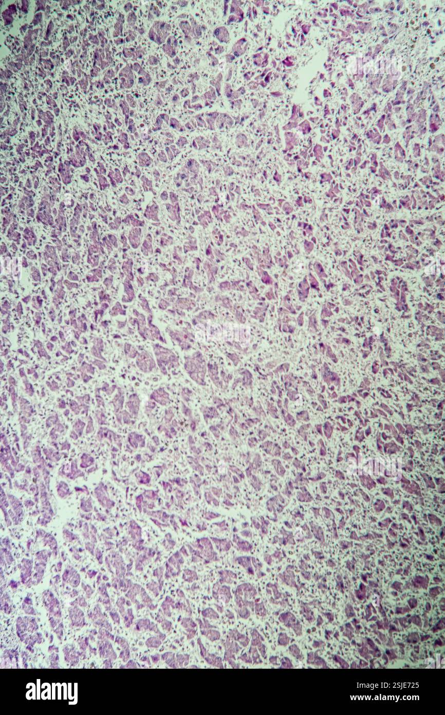 Liver diseased tissue under the microscope 100x Stock Photo - Alamy