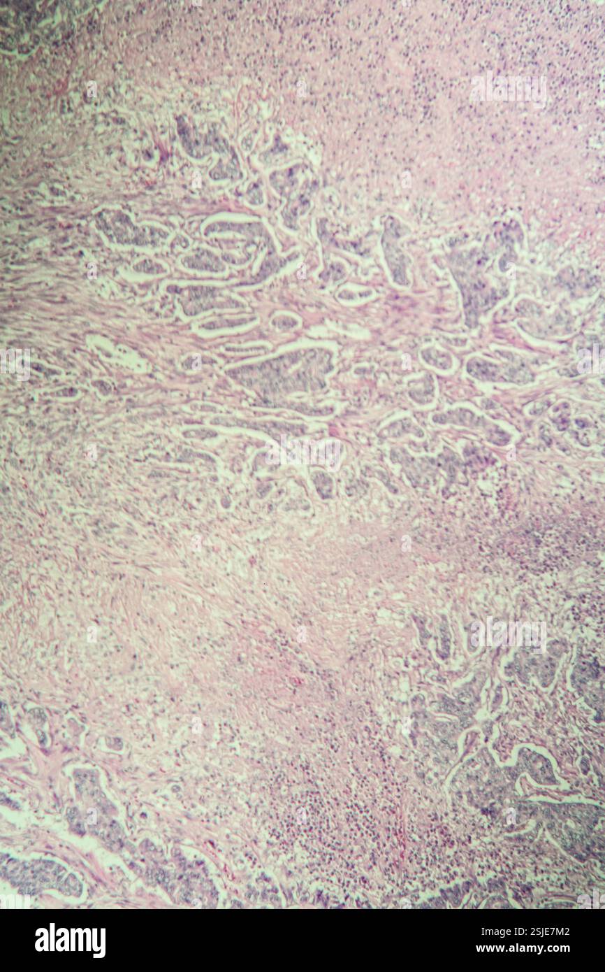 Cancer tissue under the microscope 100x Stock Photo - Alamy