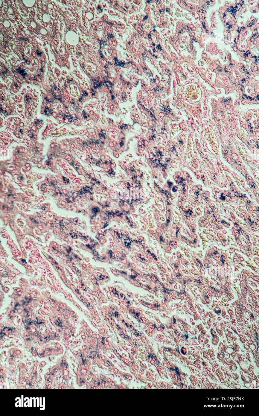 Diseased liver under the microscope 200x Stock Photo - Alamy