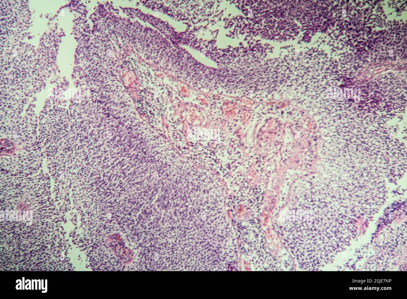 Tumor diseased tissue under the microscope 100x Stock Photo - Alamy