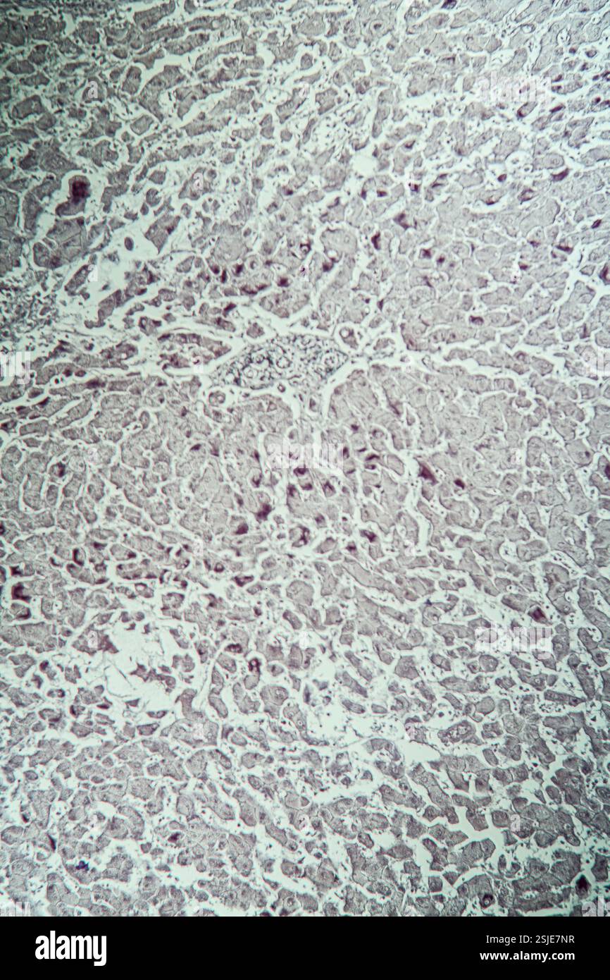 Diseased liver tissue under the microscope 100x Stock Photo - Alamy