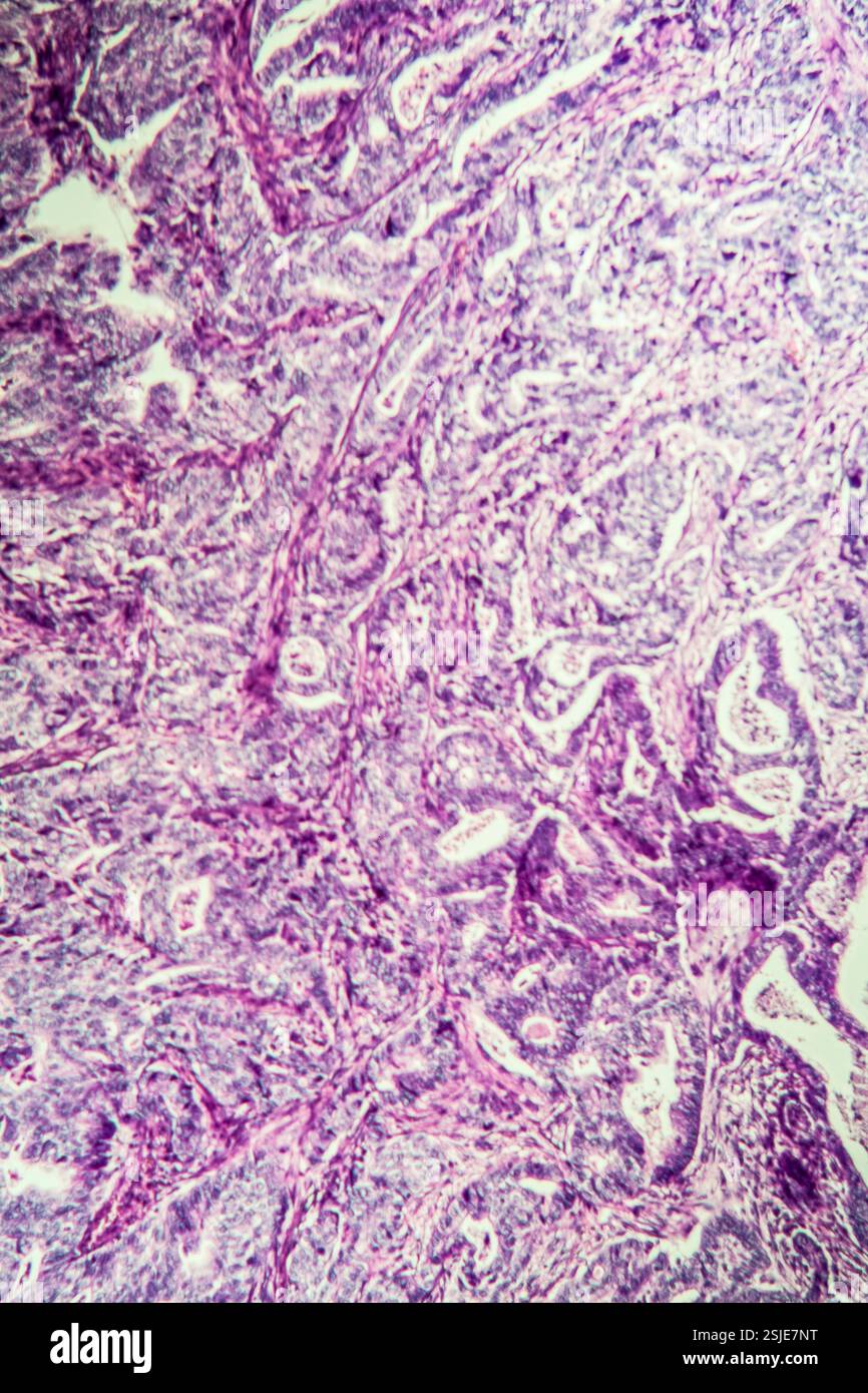 Carcinoma Tissue section under the microscope 100x Stock Photo - Alamy