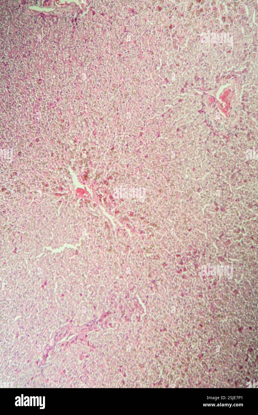 Liver disease under the microscope 100x Stock Photo - Alamy
