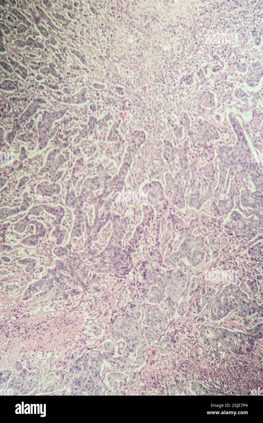 Cancer tissue under the microscope 100x Stock Photo - Alamy