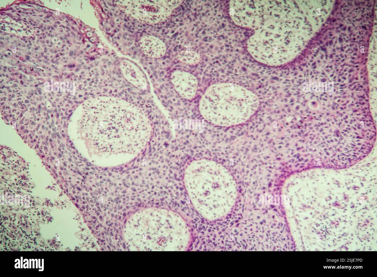 Tumor Diseased tissue under the microscope 100x Stock Photo - Alamy