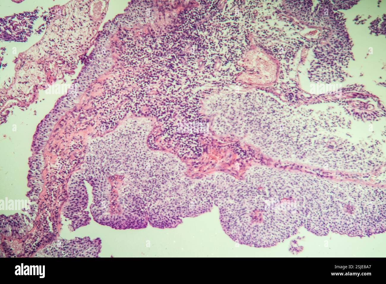 Tumor diseased tissue under the microscope 100x Stock Photo - Alamy