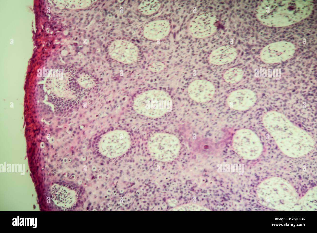 Tumor Diseased tissue under the microscope 100x Stock Photo - Alamy
