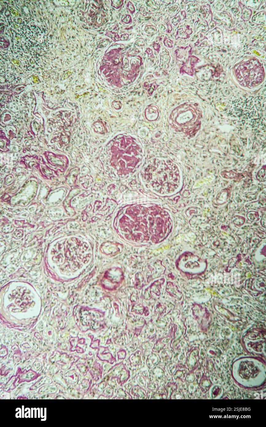 Kidney diseased tissue under the microscope 100x Stock Photo - Alamy