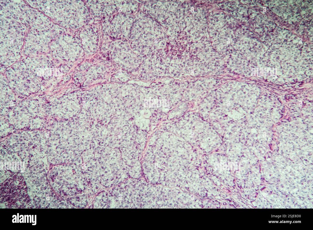 Ovarian diseased tissue under the microscope 100x Stock Photo - Alamy