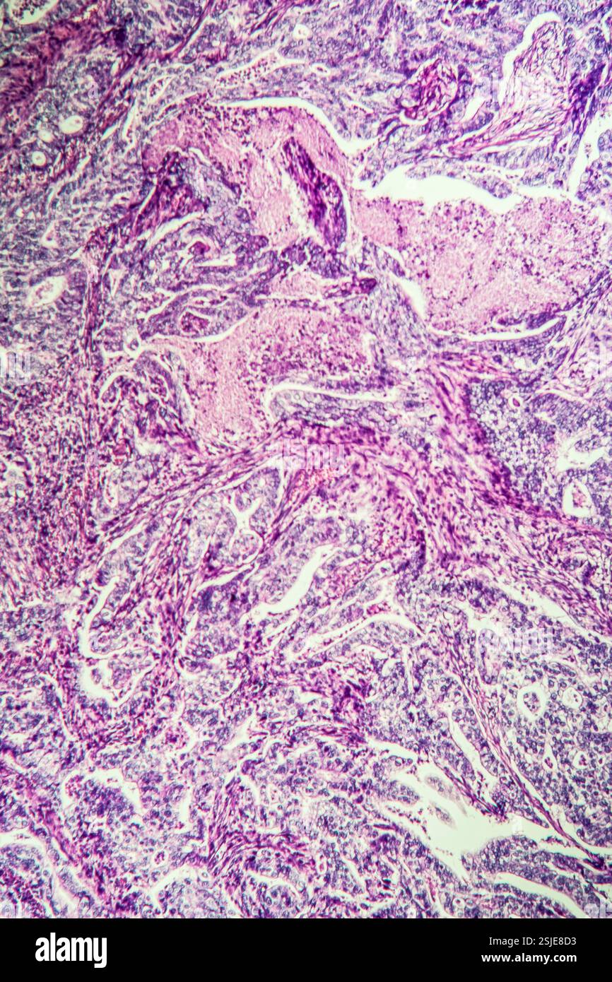 Carcinoma tissue section under the microscope 100x hi-res stock ...