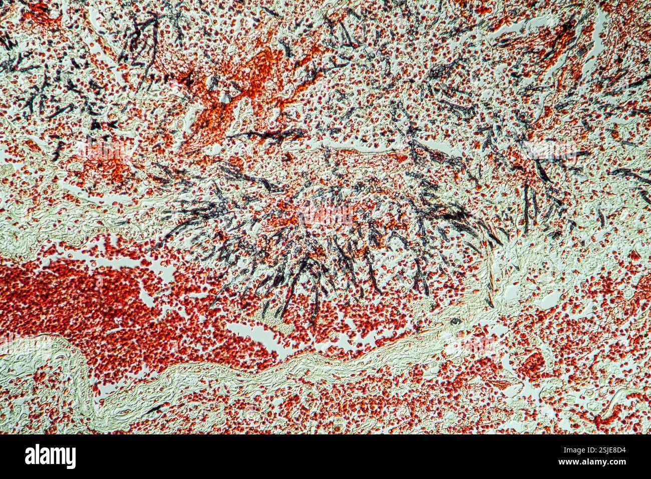 AIDS lung tissue under the microscope 200x Stock Photo - Alamy