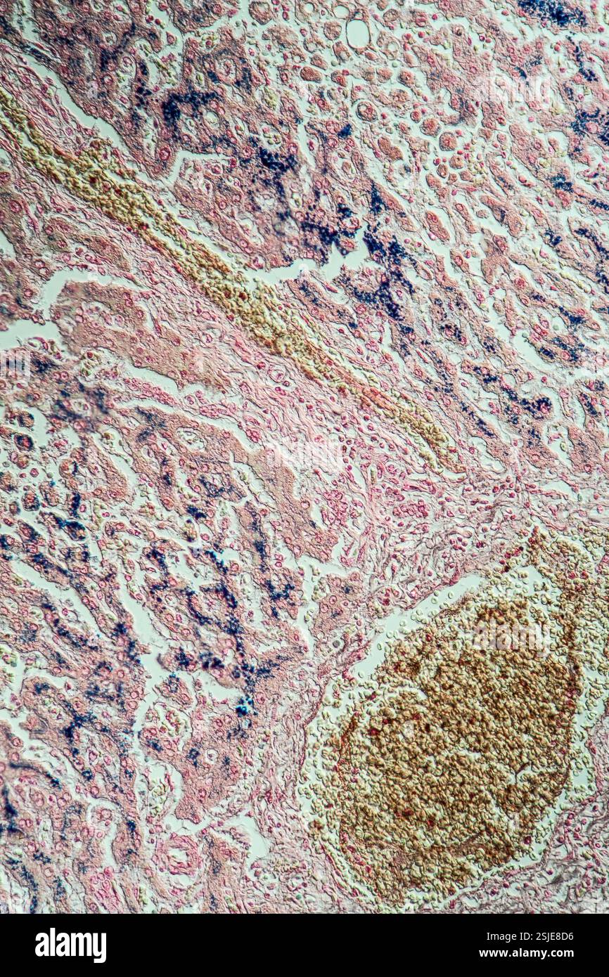 Liver with hemosiderosis under the microscope 200x hi-res stock ...