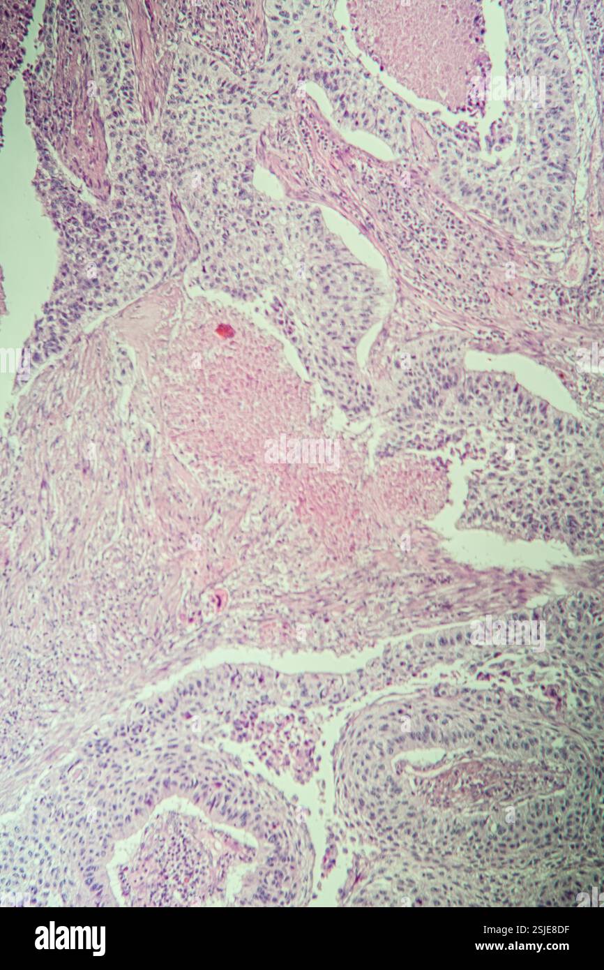 Cancerous tissue under the microscope 100x Stock Photo - Alamy