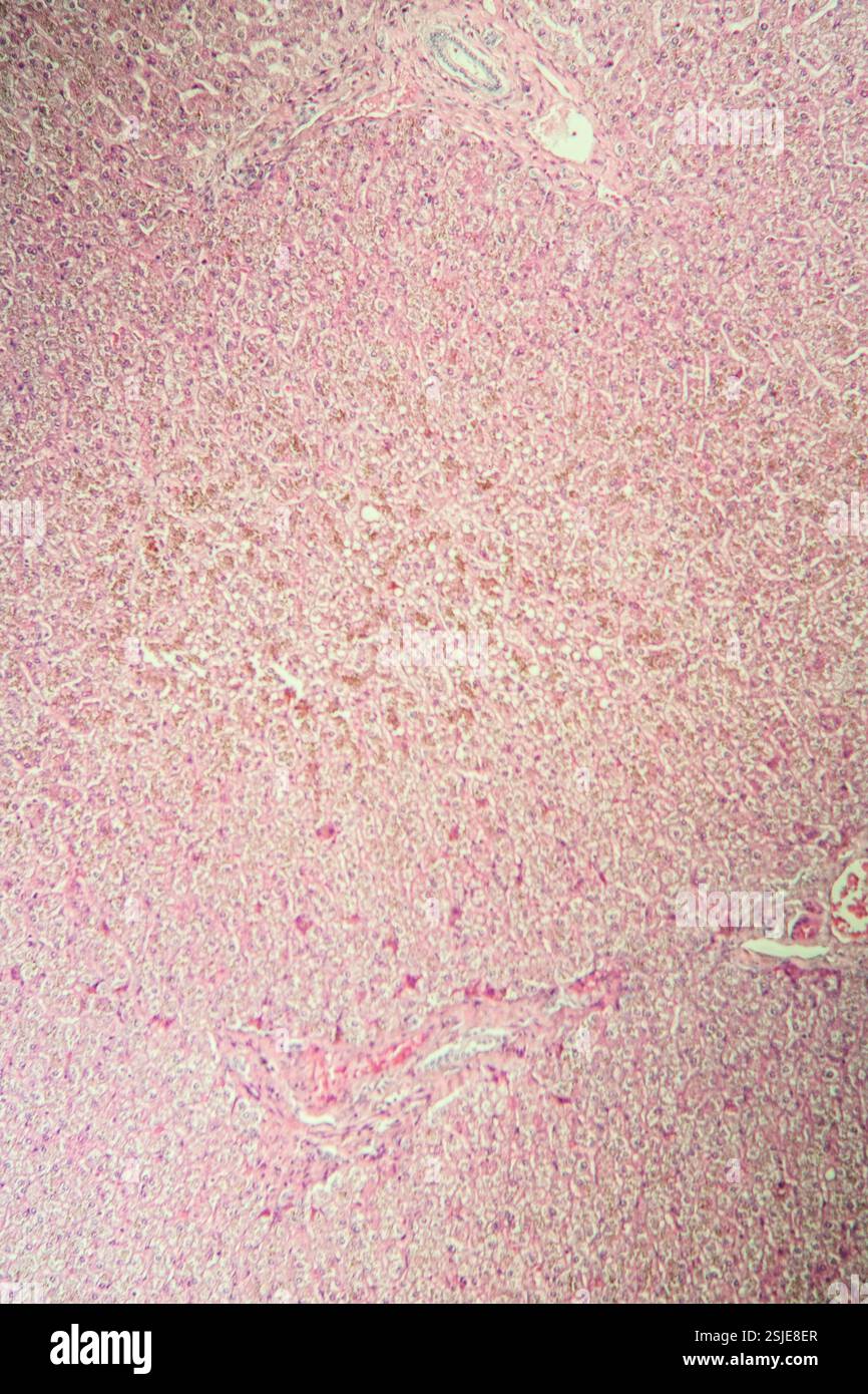 Liver disease under the microscope 100x Stock Photo - Alamy